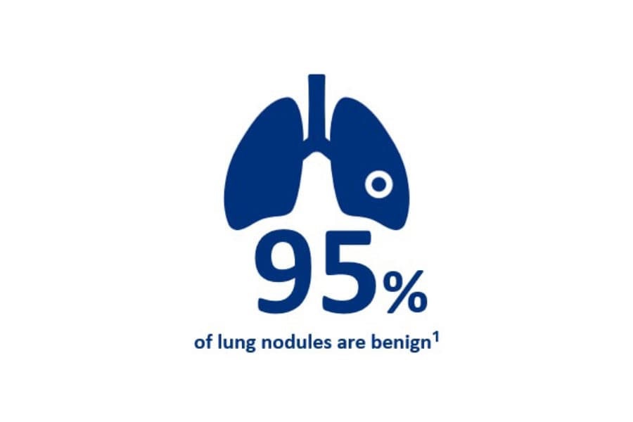 Simple Blood Test for Lung Nodules | Biodesix